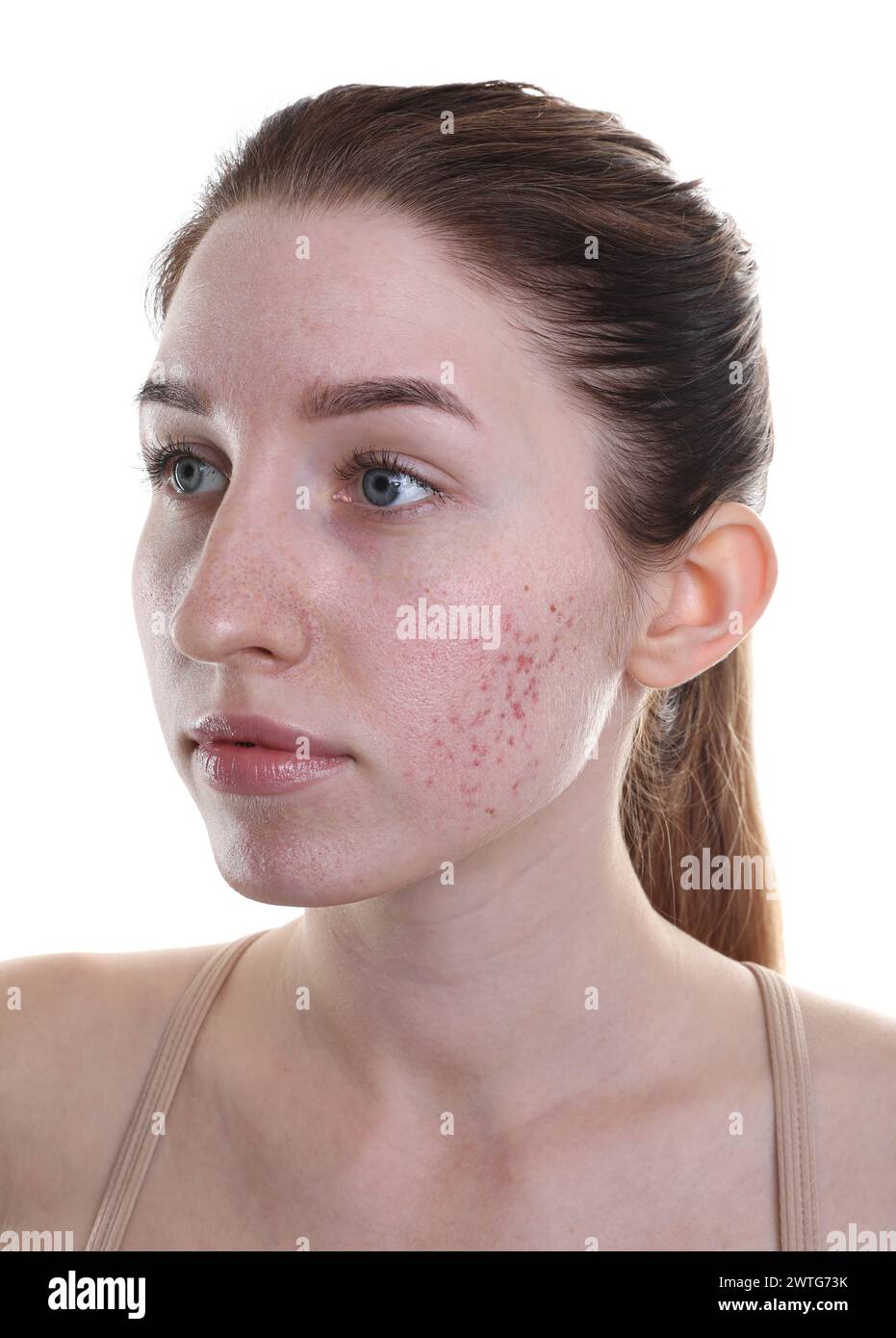 Young woman with acne problem on white background Stock Photo - Alamy