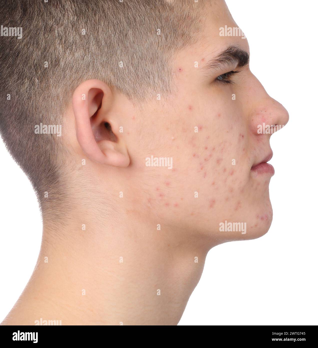 Adult acne isolated hi-res stock photography and images - Alamy