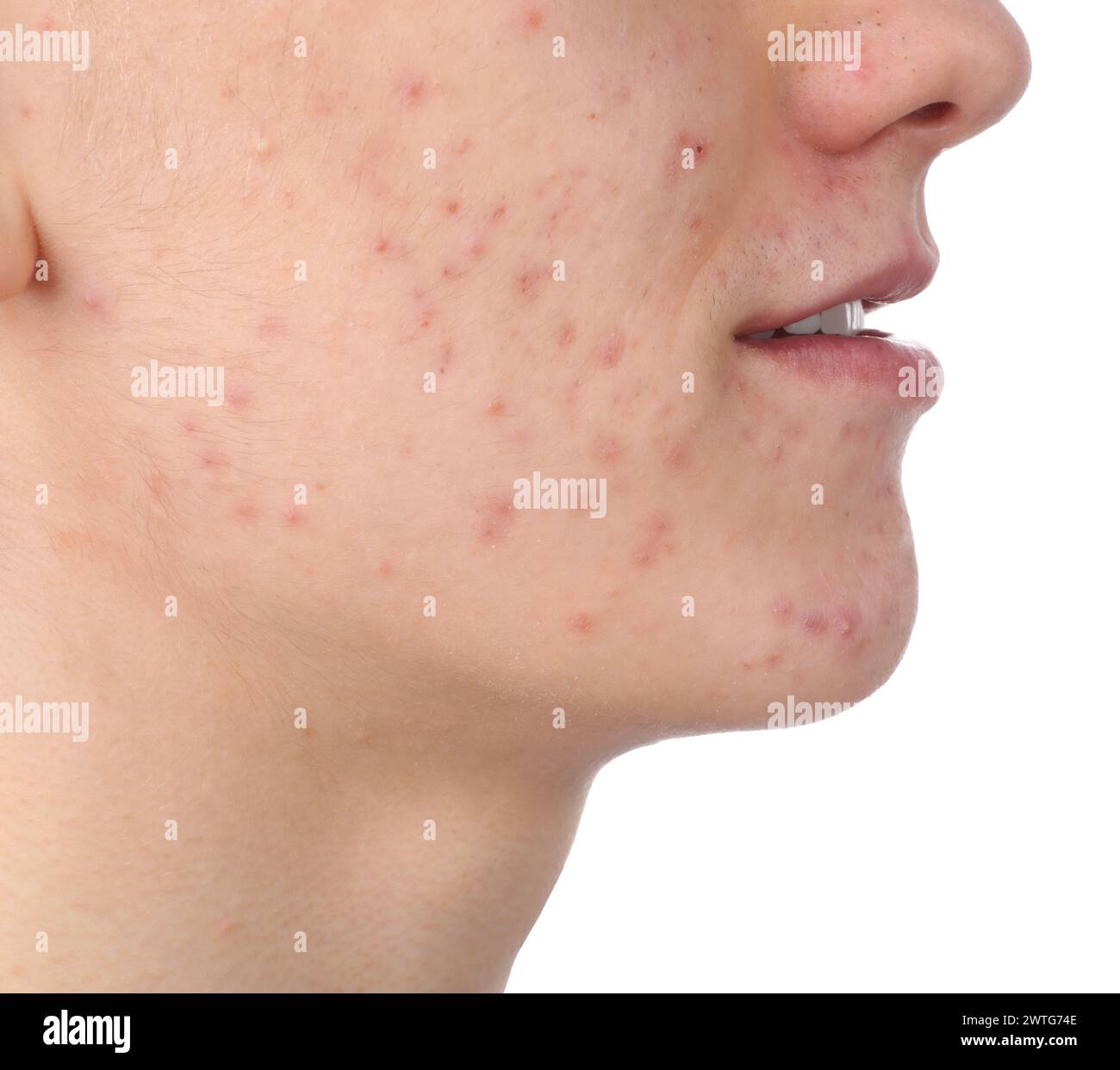 Man with acne hi-res stock photography and images - Alamy