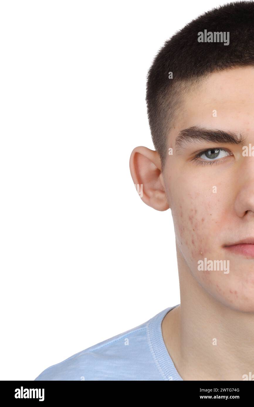Acne scars on cheek hi-res stock photography and images - Alamy