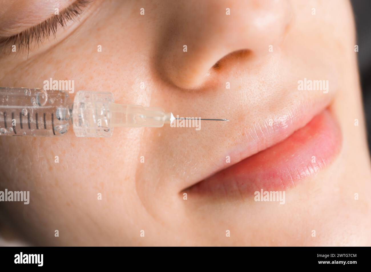 Client getting lips injection, closeup. Cosmetology procedure Stock ...