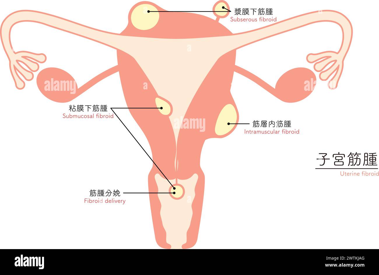Diagrammatic Illustration Of Uterine Fibroids Anatomy Of The Uterus