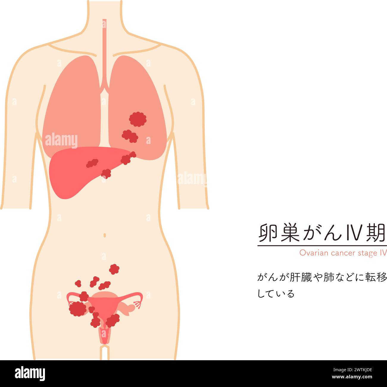 Diagrammatic Illustration Of Stage Iv Ovarian Cancer Anatomy Of The Uterus And Ovaries Anatomy