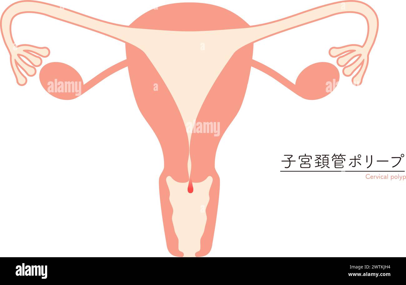 Diagrammatic Illustration Of Cervical Polyps Anatomy Of The Uterus And