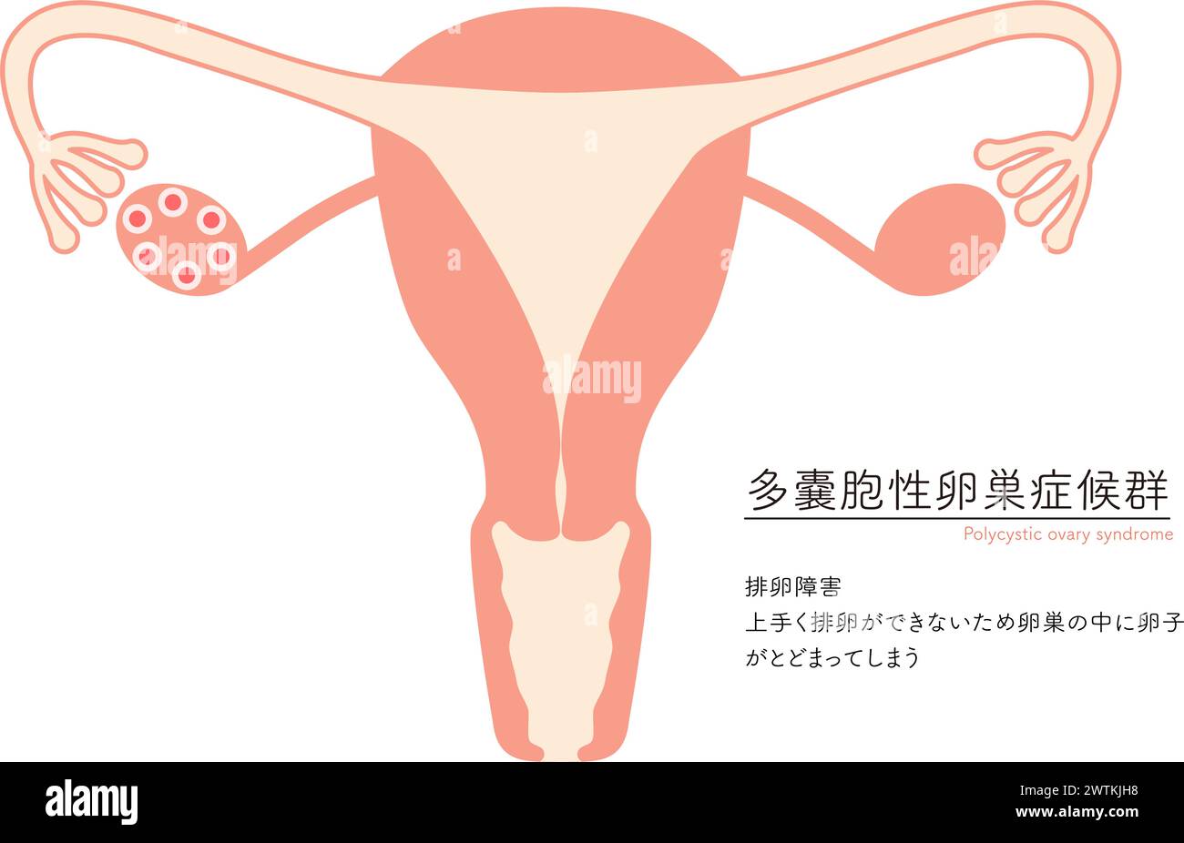 Diagrammatic Illustration Of Polycystic Ovary Syndrome Ovulation