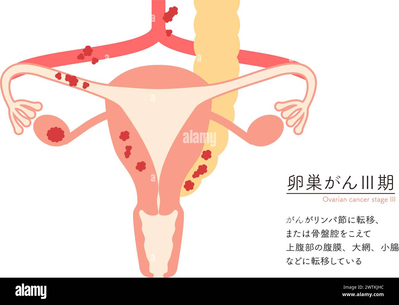 Diagrammatic Illustration Of Stage Iii Ovarian Cancer Anatomy Of The