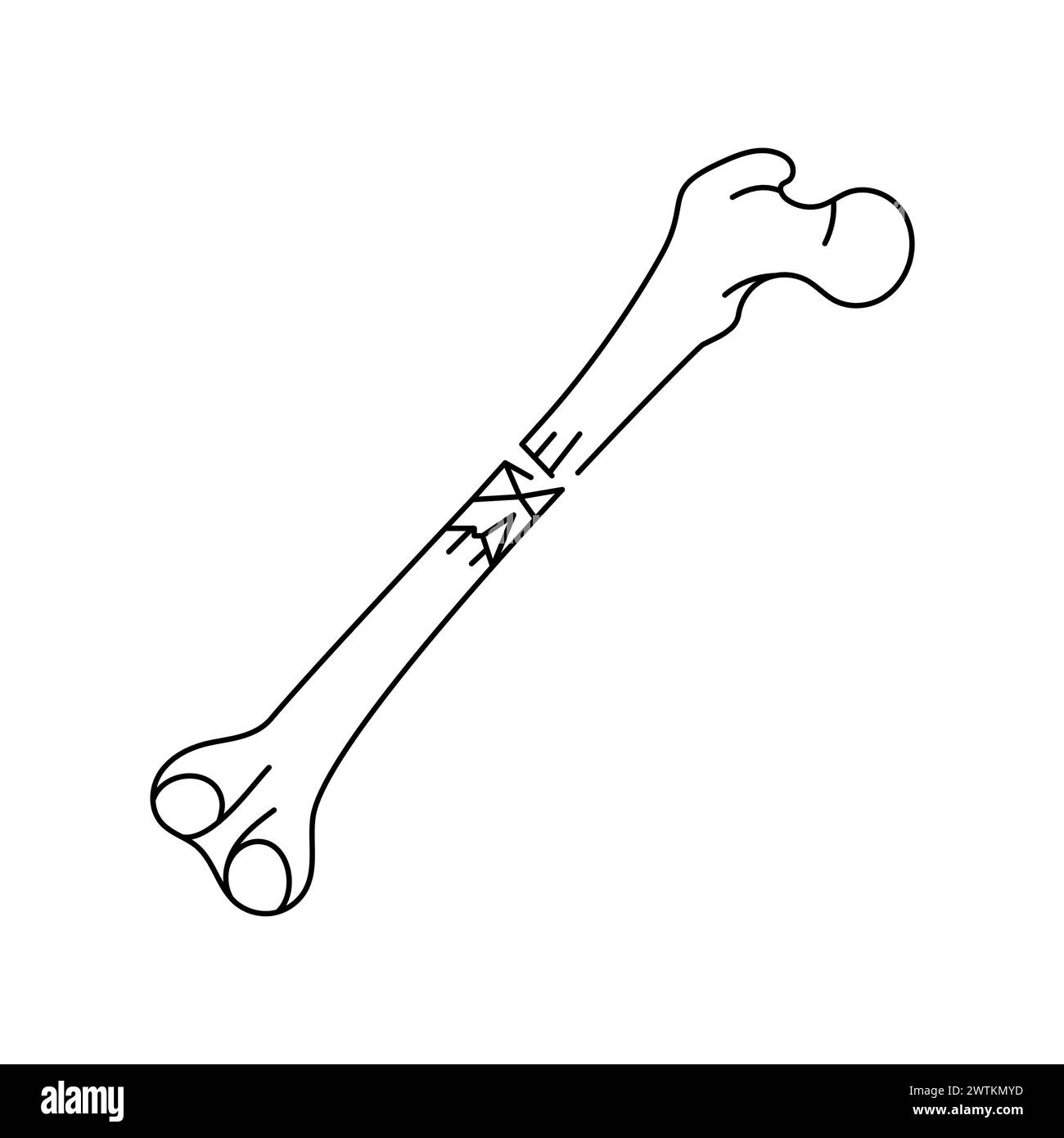 Spiral Bone Fracture Stock Vector Images Alamy