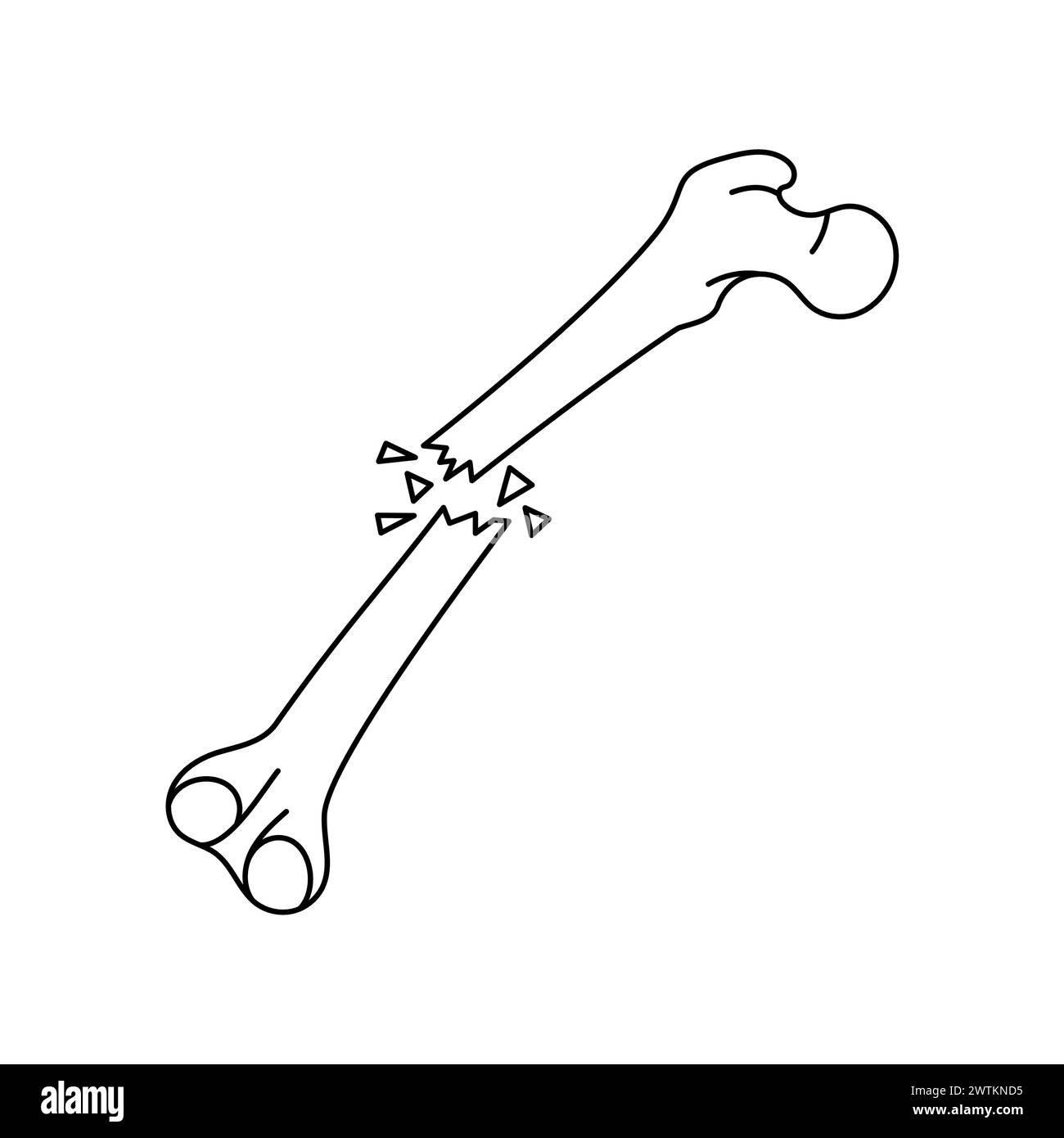 Greenstick Bone Fracture Stock Vector Images Alamy