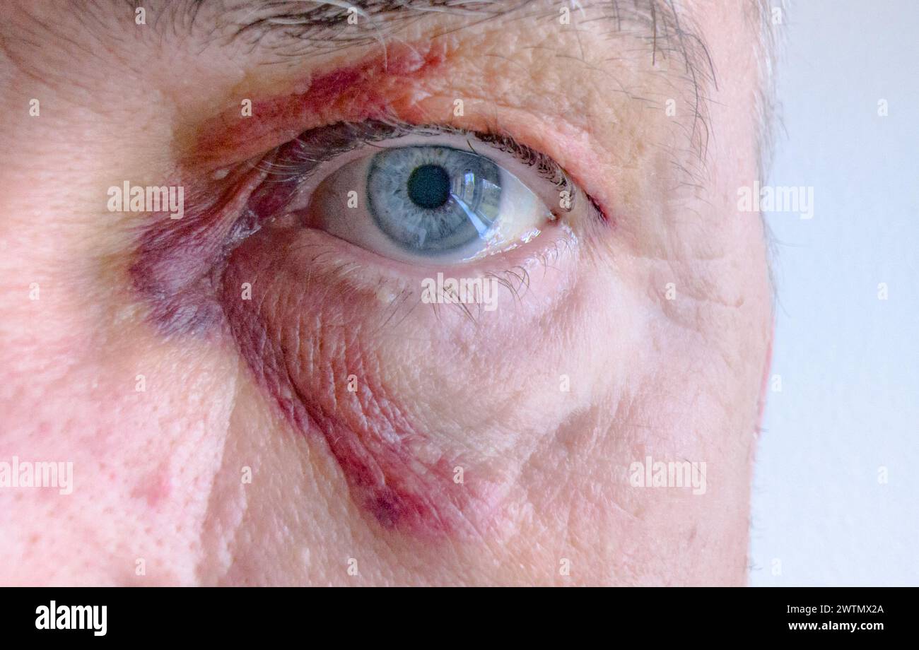 16 March 2024, Hamburg: Close-up of a bruise on a man's eye ...