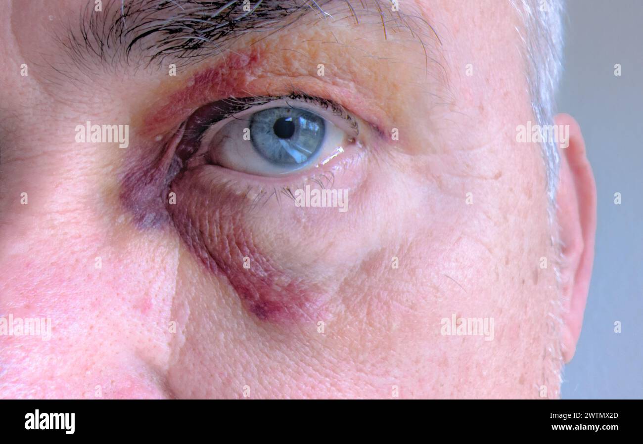 16 March 2024, Hamburg: Close-up of a bruise on a man's eye ...