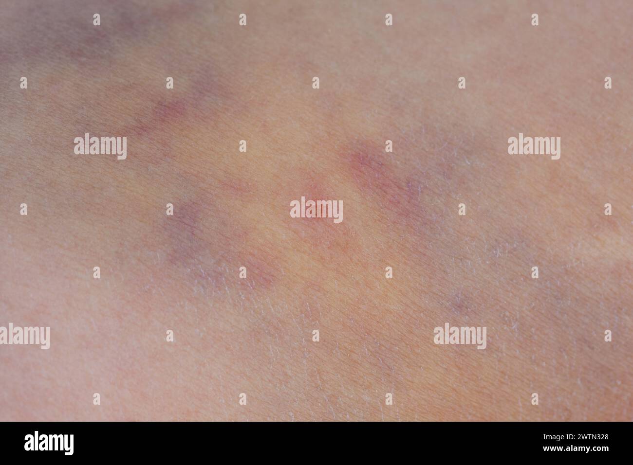 Skin discoloration hi-res stock photography and images - Alamy