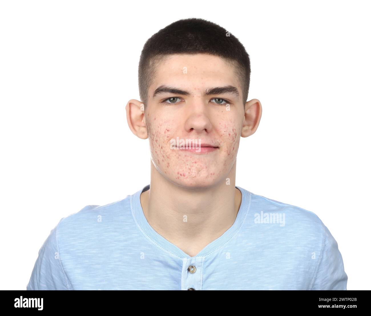 Young man with acne problem isolated on white Stock Photo - Alamy