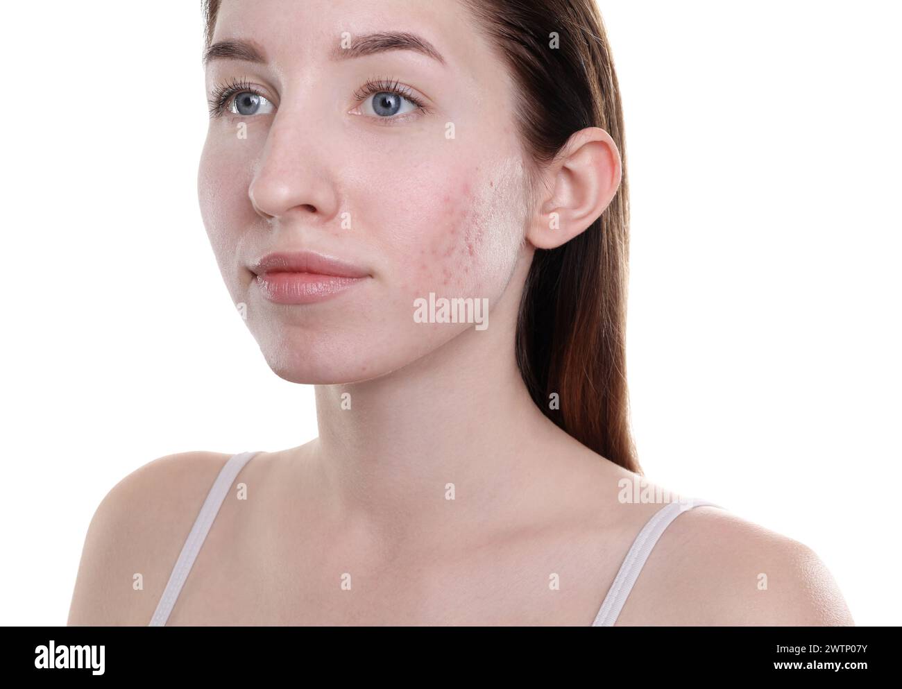 Young woman with acne problem on white background Stock Photo - Alamy