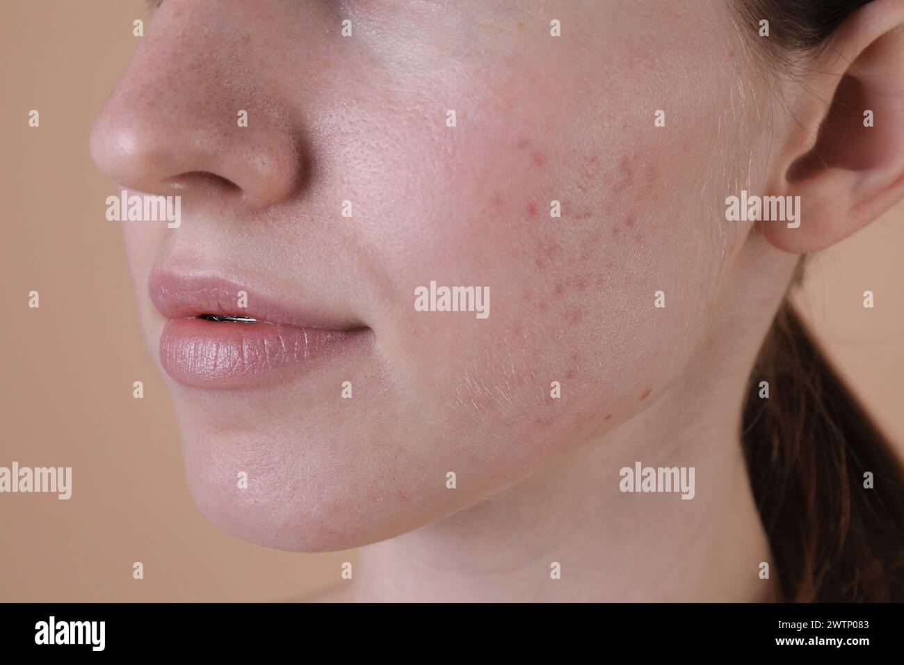 Young woman with acne problem on beige background, closeup Stock Photo ...
