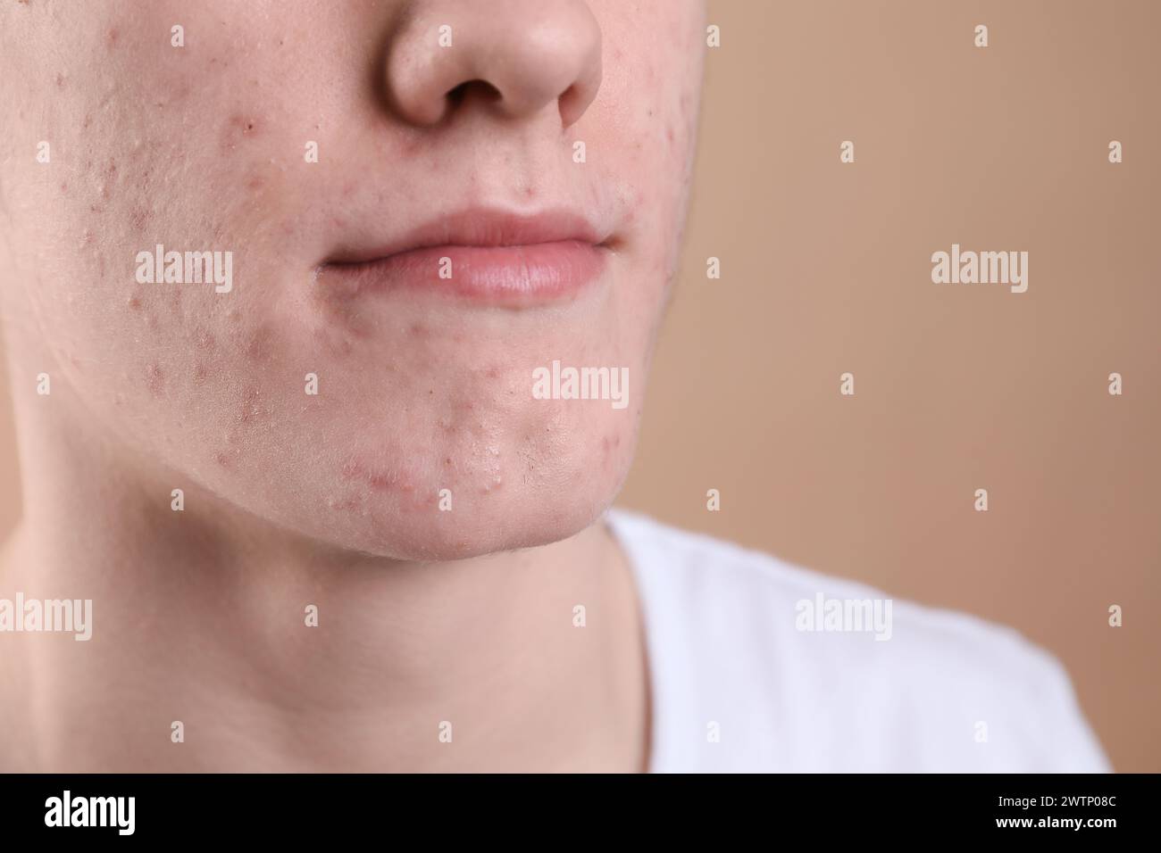 Young man with acne problem on beige background, closeup Stock Photo ...