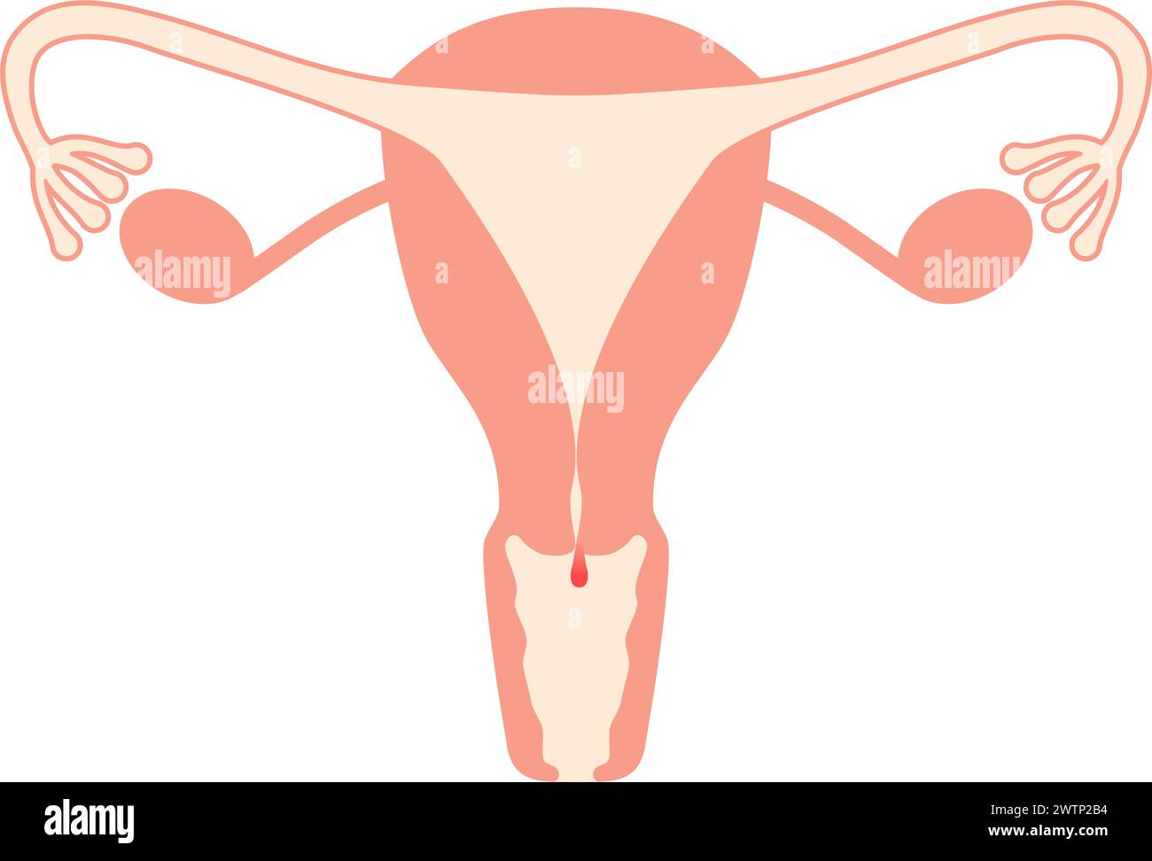 Diagrammatic Illustration Of Cervical Polyps Anatomy Of The Uterus And