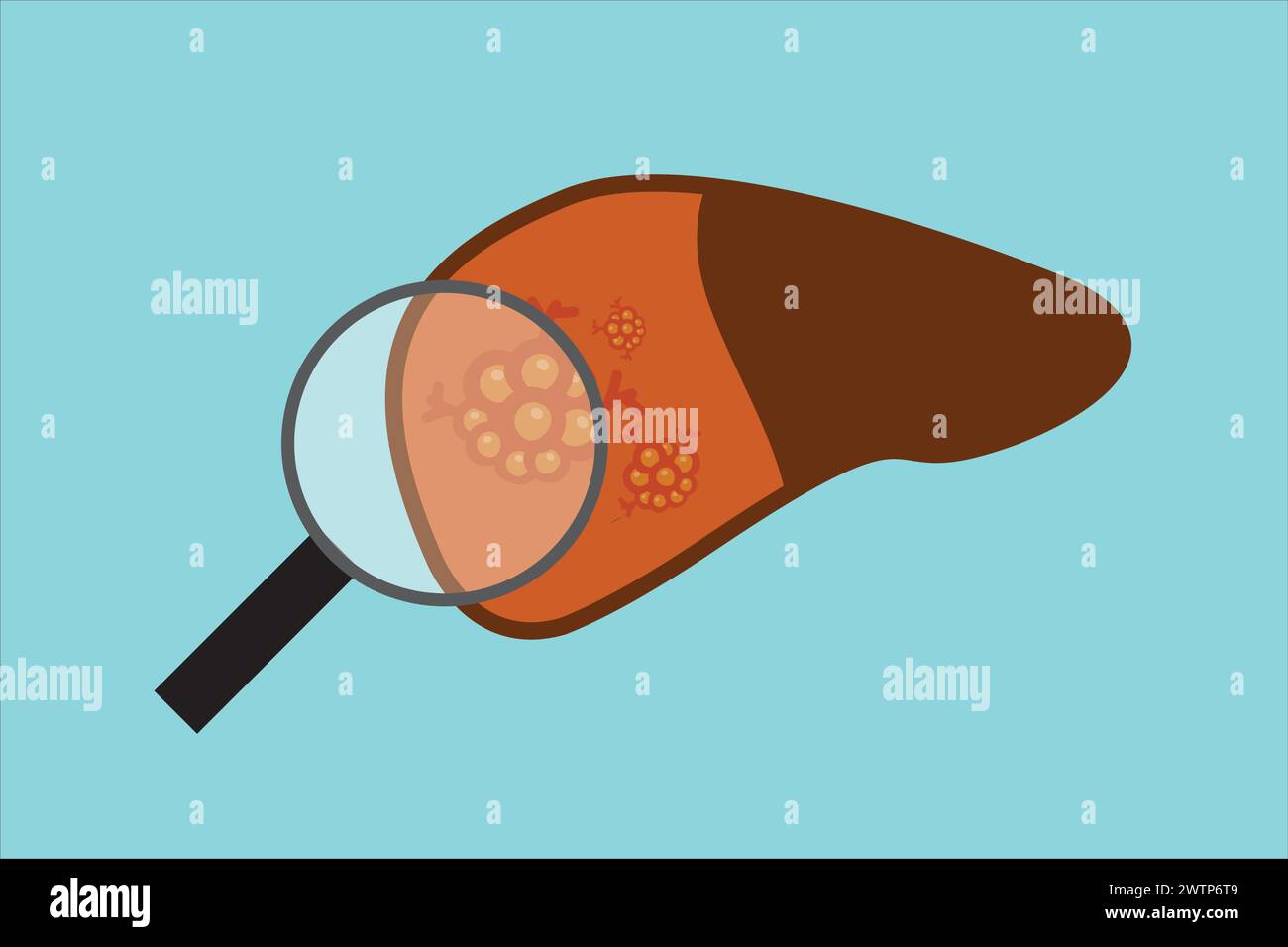 Liver cancer, oncology and medicine, liver tumor vector icon, vector ...