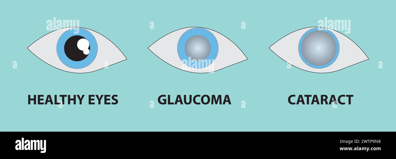 illustration of a healthy eye, glaucoma, cataract Stock Vector Image ...