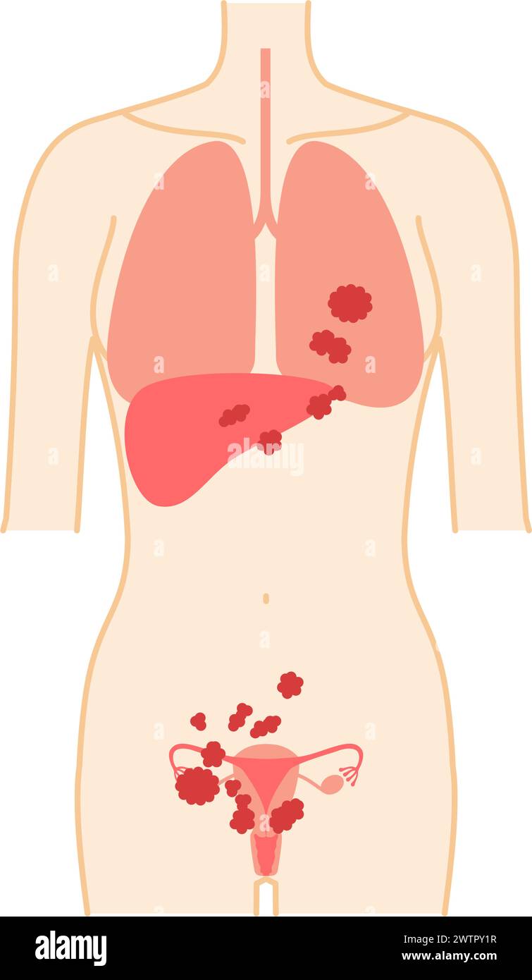 Diagrammatic Illustration Of Stage Iv Ovarian Cancer Anatomy Of The