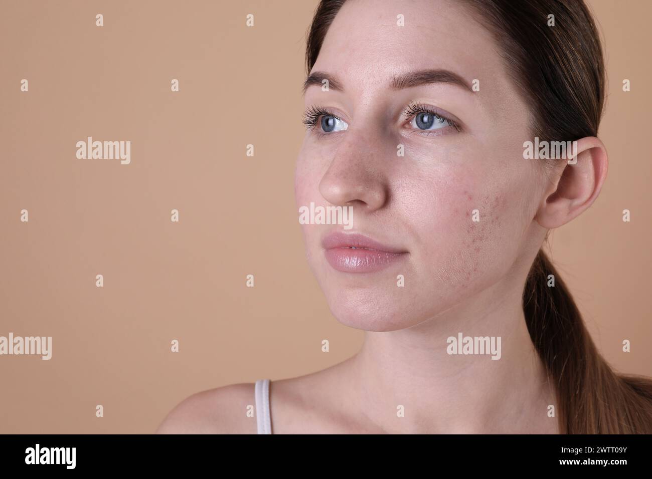 Young woman with acne problem on beige background. Space for text Stock ...