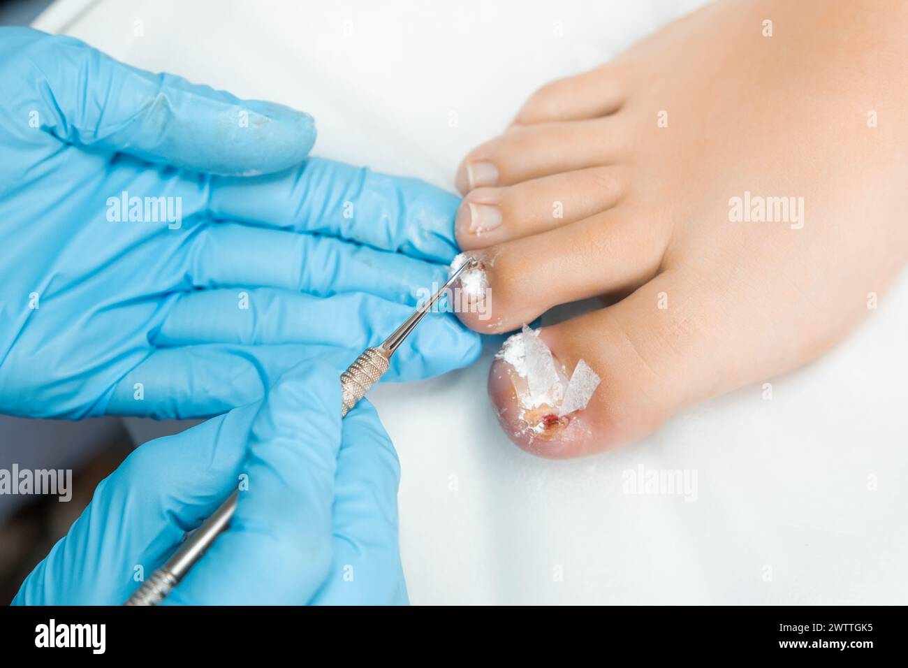 A foot care specialist podologist in blue gloves conducts a medical ...
