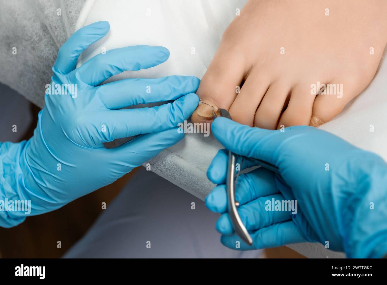 The podologist cut ingrown toenail with nippers. Toe nail dressing ...