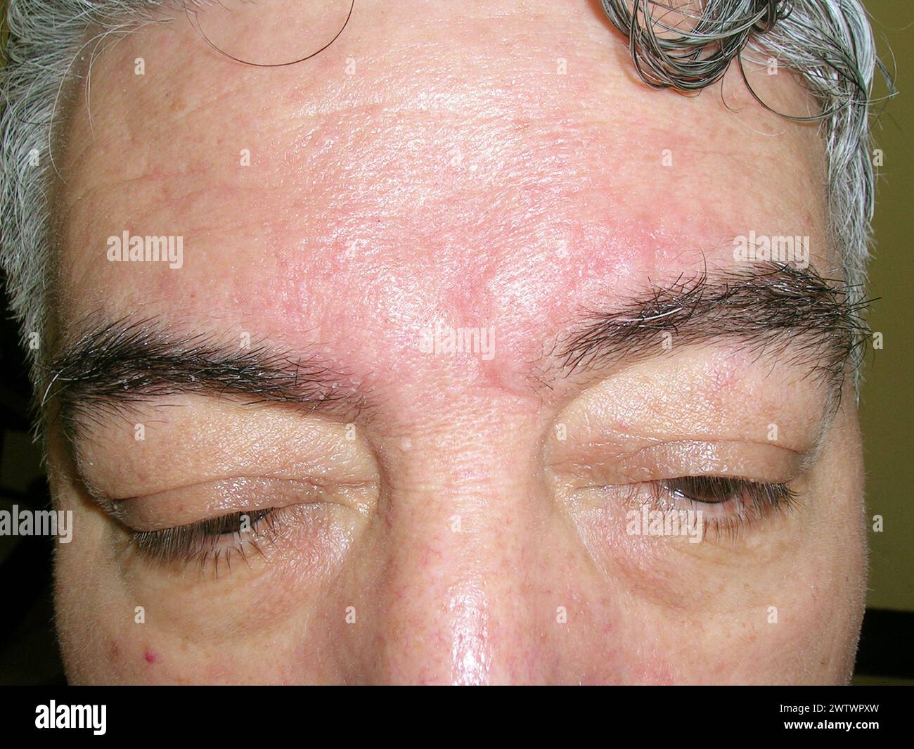 Editorial use only Seborrheic dermatitis on a male patient's glabella ...