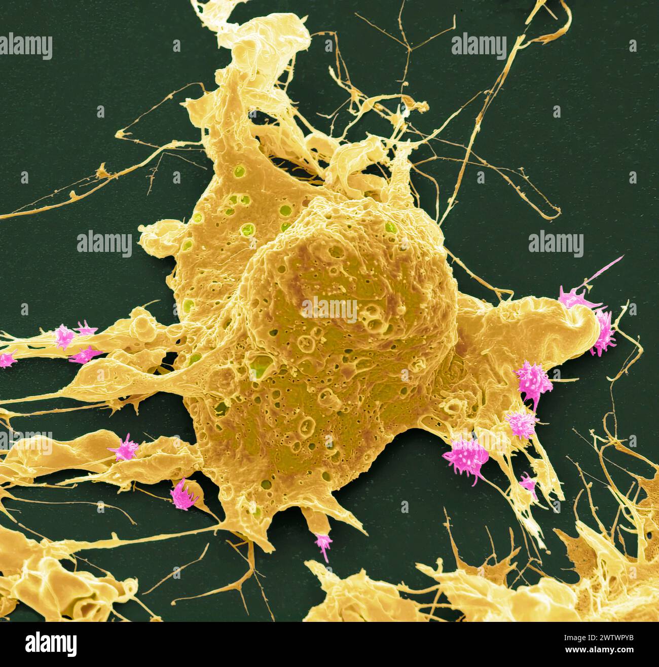 Chemotherapy induced cell death. Coloured scanning electron micrograph ...