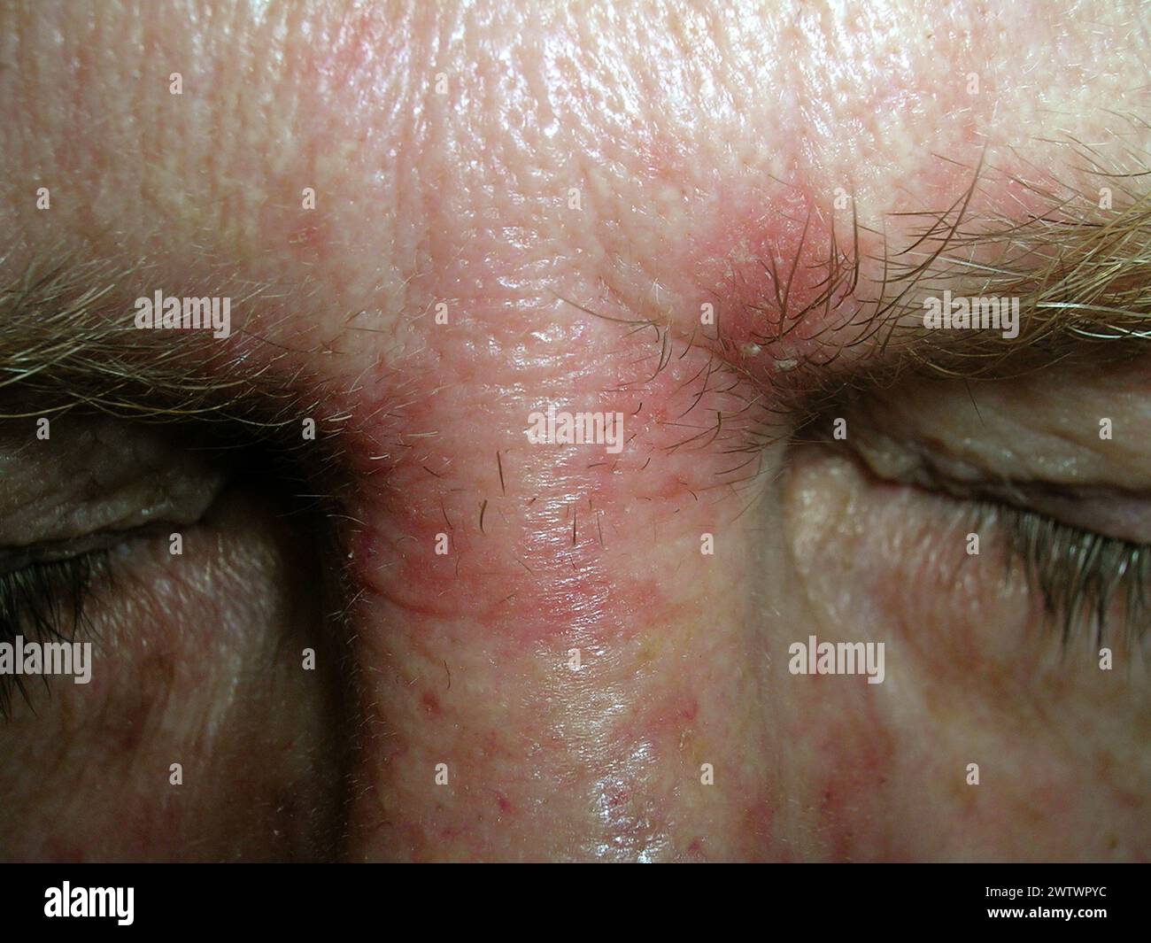 Editorial use only Seborrheic dermatitis on a patient's glabella. This ...