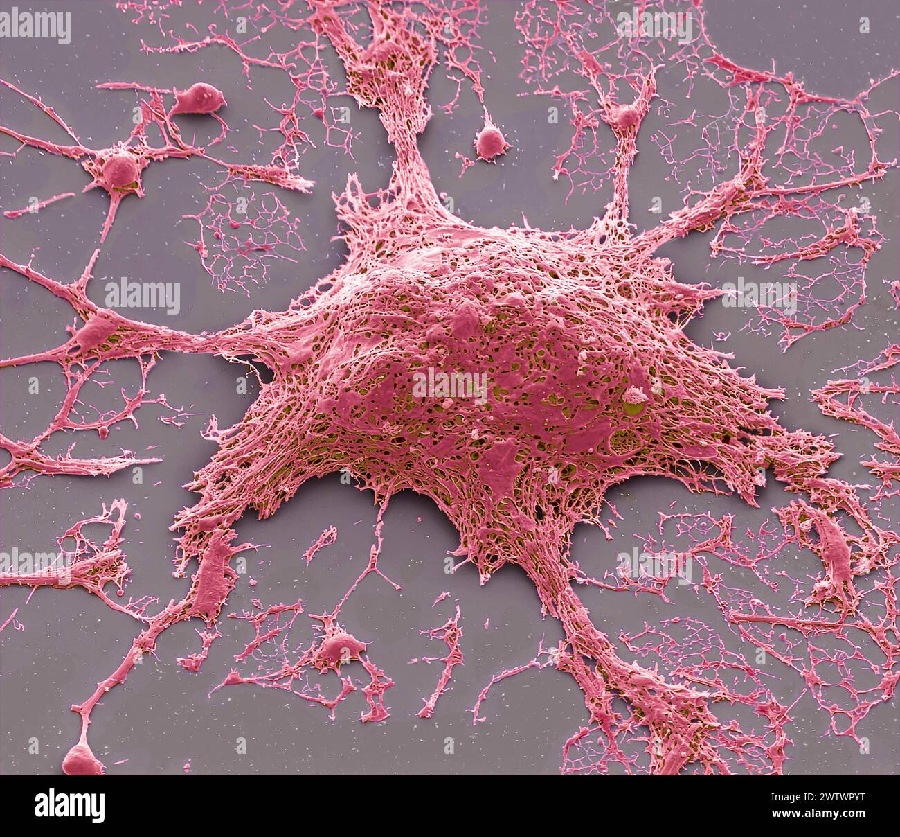 Chemotherapy induced cell death. Coloured scanning electron micrograph ...