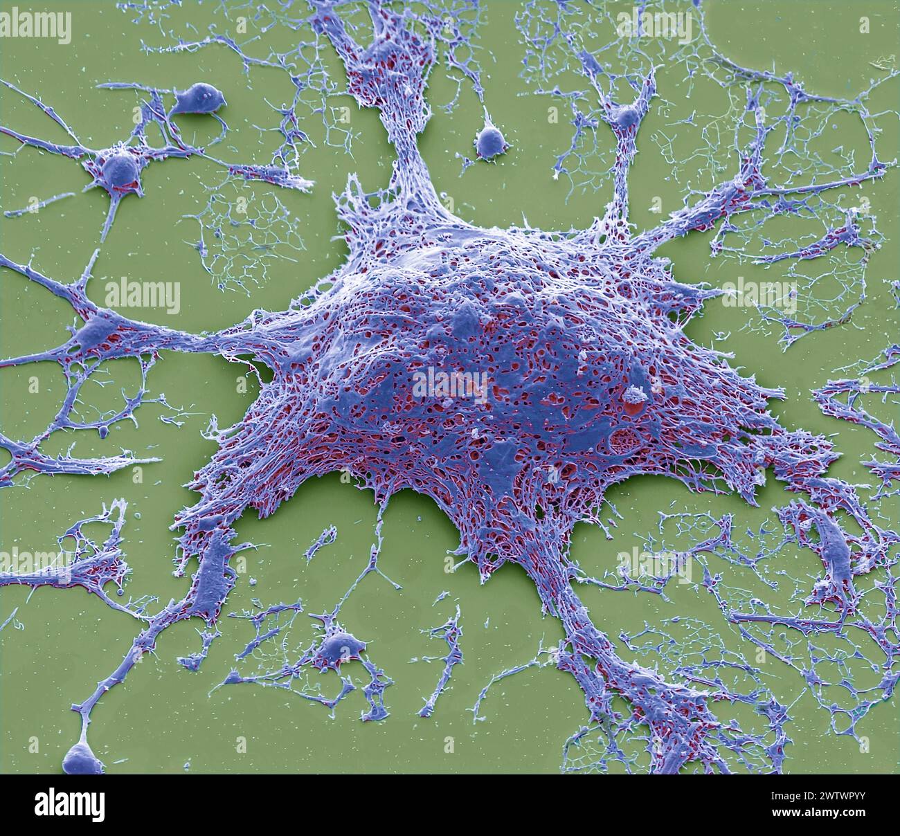 Chemotherapy induced cell death. Coloured scanning electron micrograph ...