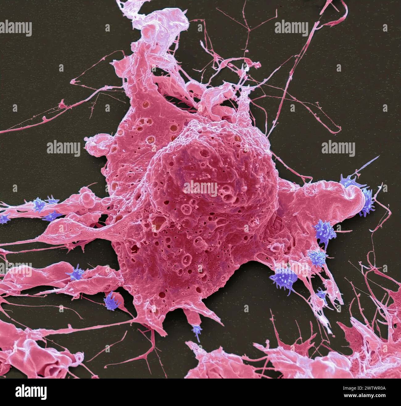Chemotherapy induced cell death. Coloured scanning electron micrograph ...