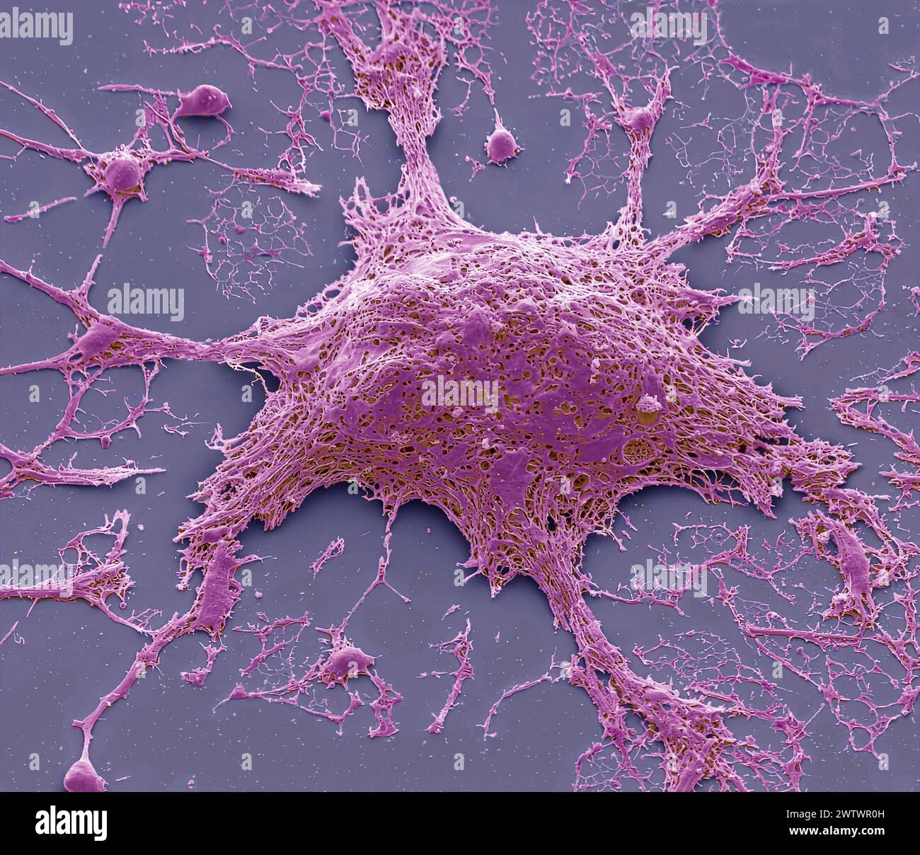 Chemotherapy induced cell death. Coloured scanning electron micrograph ...