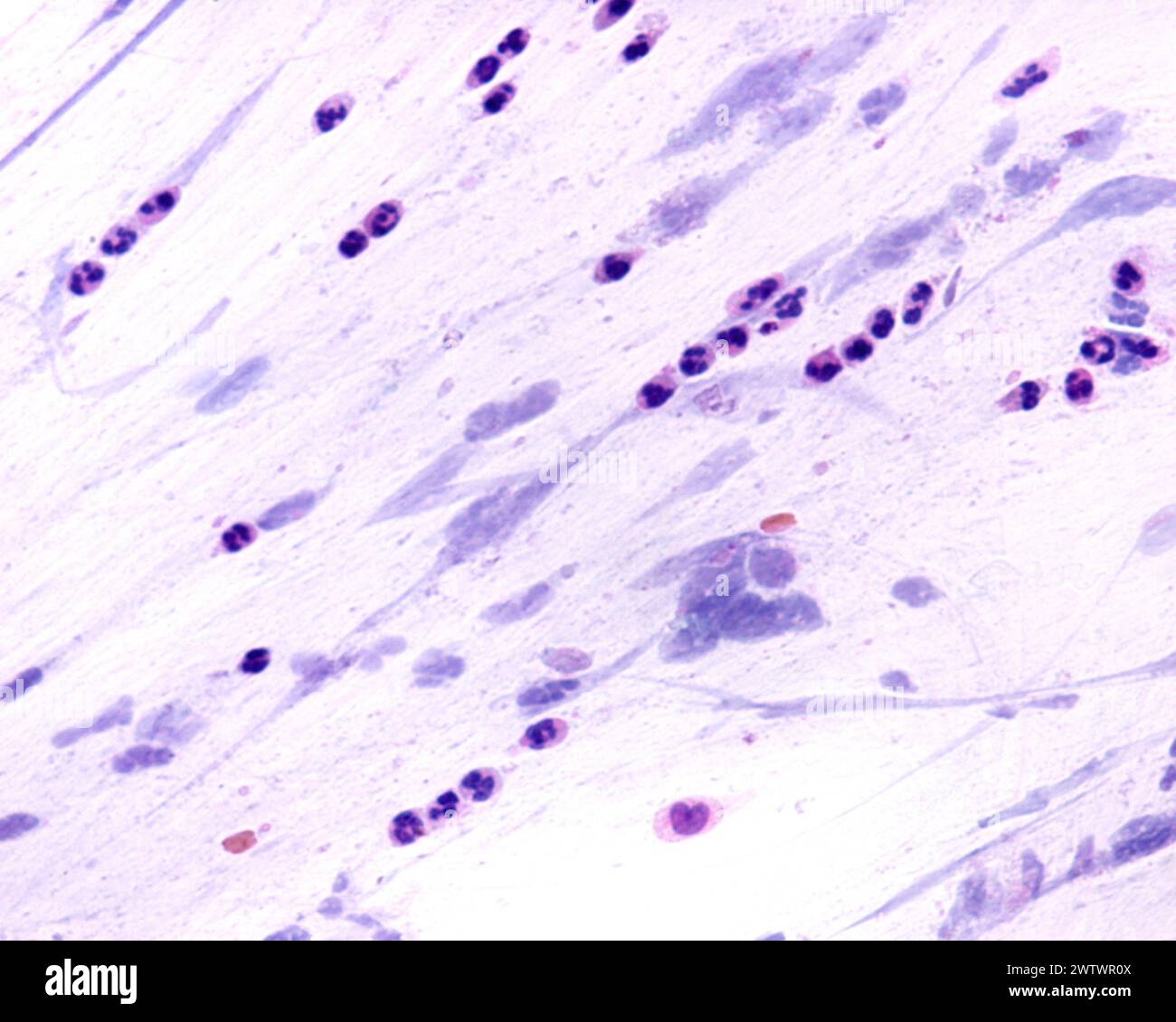 Sputum smear showing abundant neutrophil leucocytes, light micrograph ...
