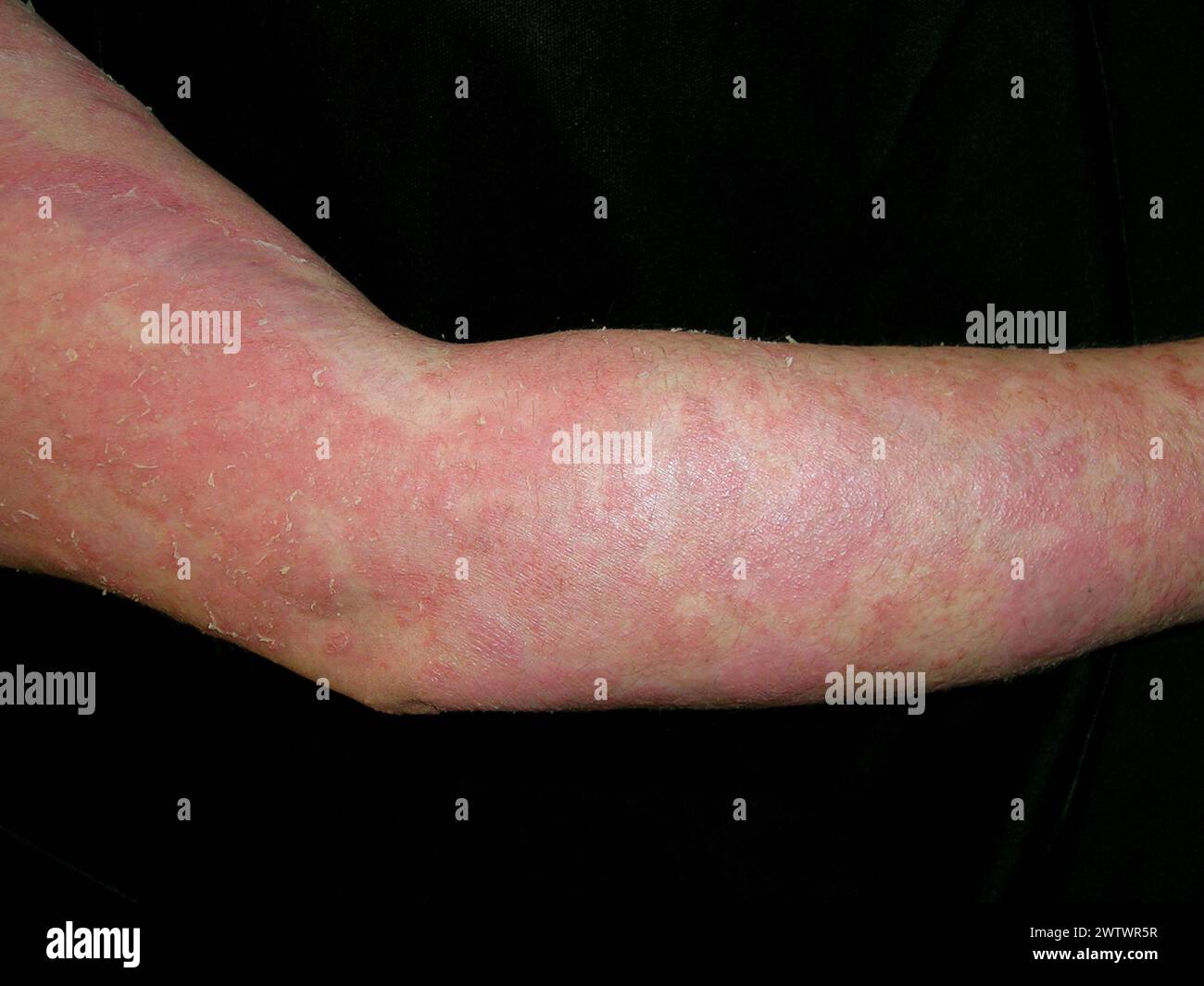 Not to be used for advertising or in a defamatory context Erythrodermic ...