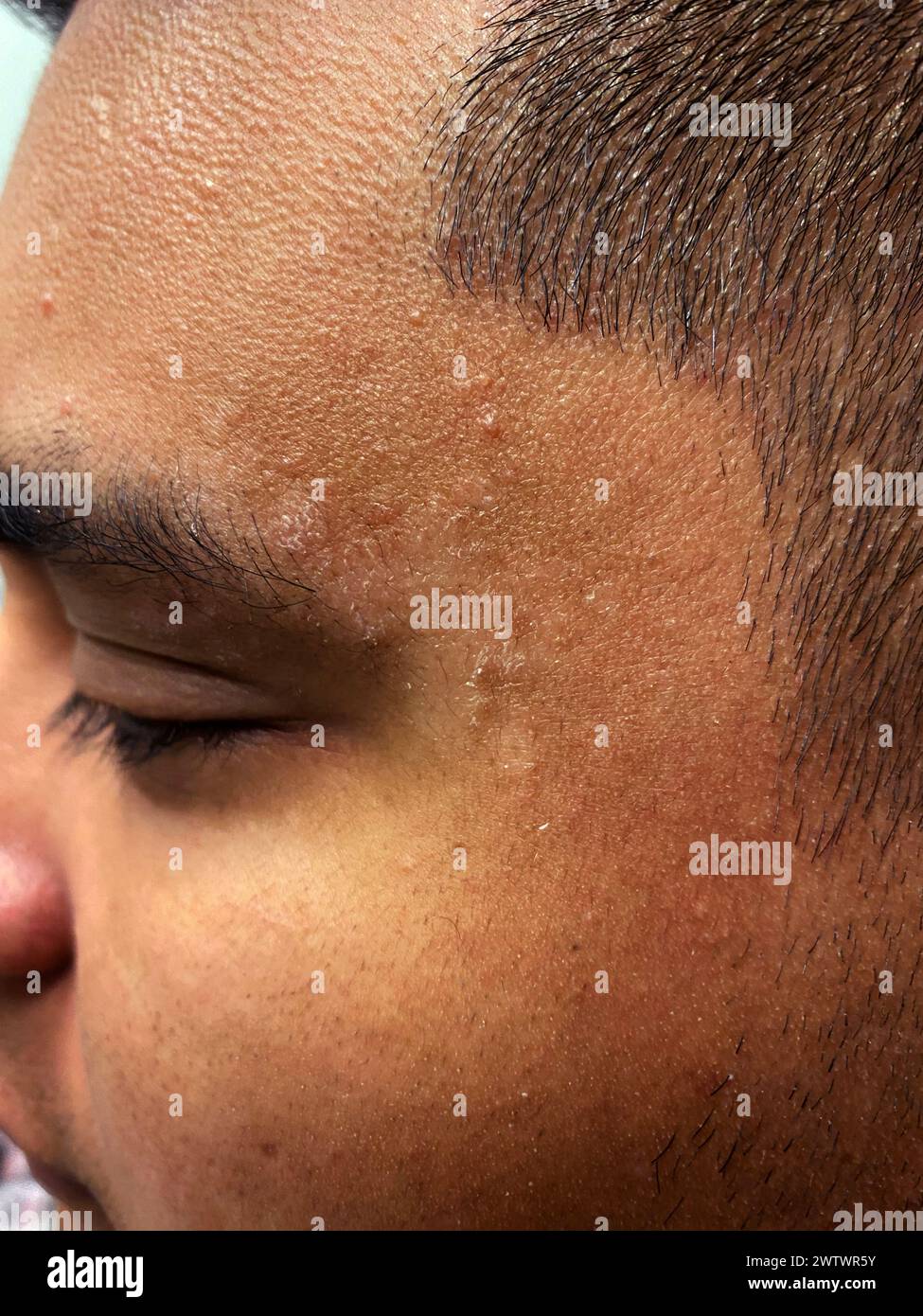 Editorial use only Seborrheic dermatitis on a male patient's face. This ...