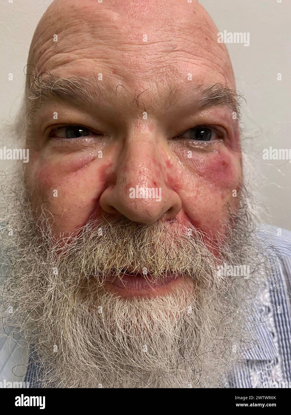Editorial use only Seborrheic dermatitis on the face of a white male ...