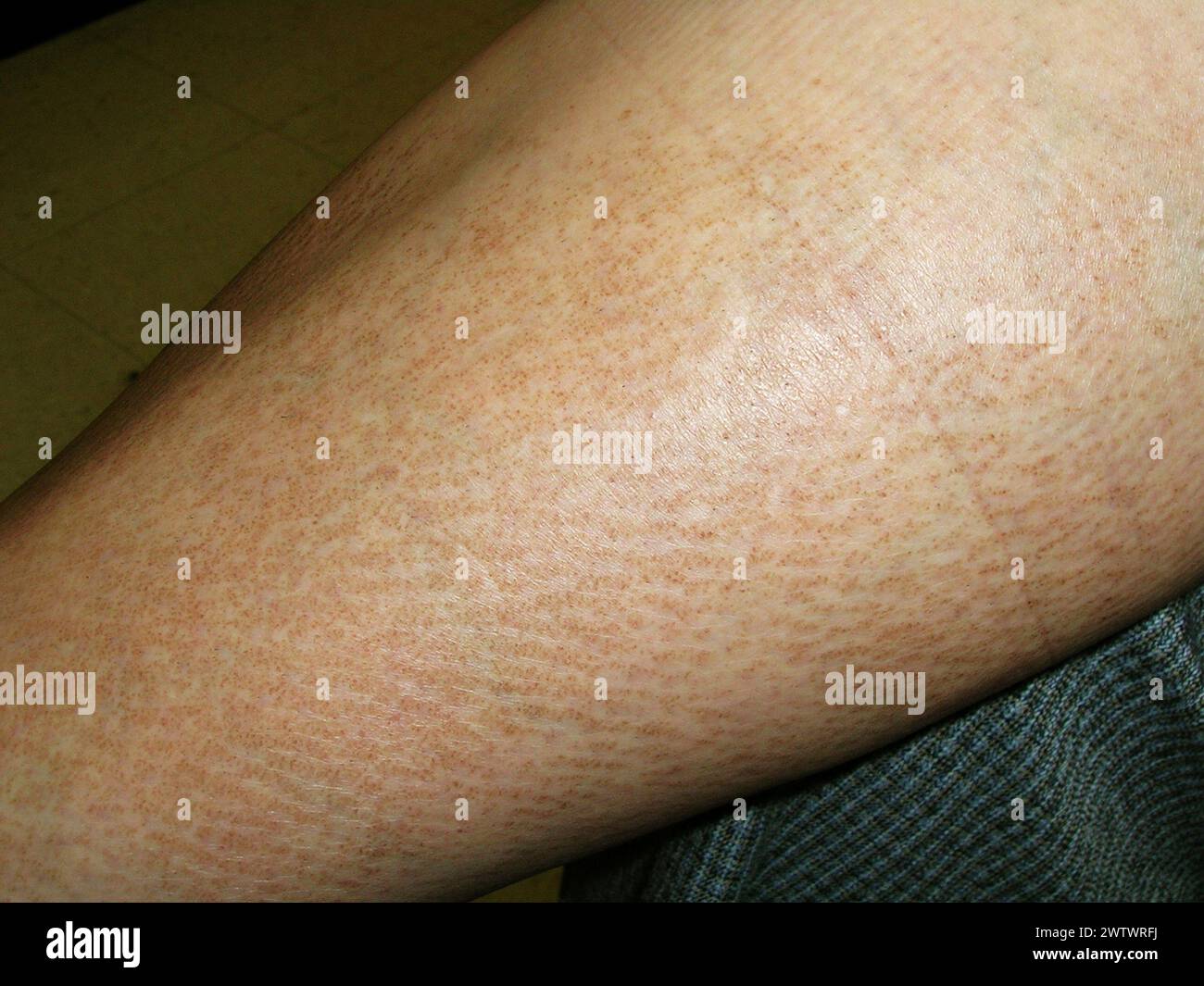 Not To Be Used For Advertising Or In A Defamatory Context Cutaneous Amyloidosis On A Patients