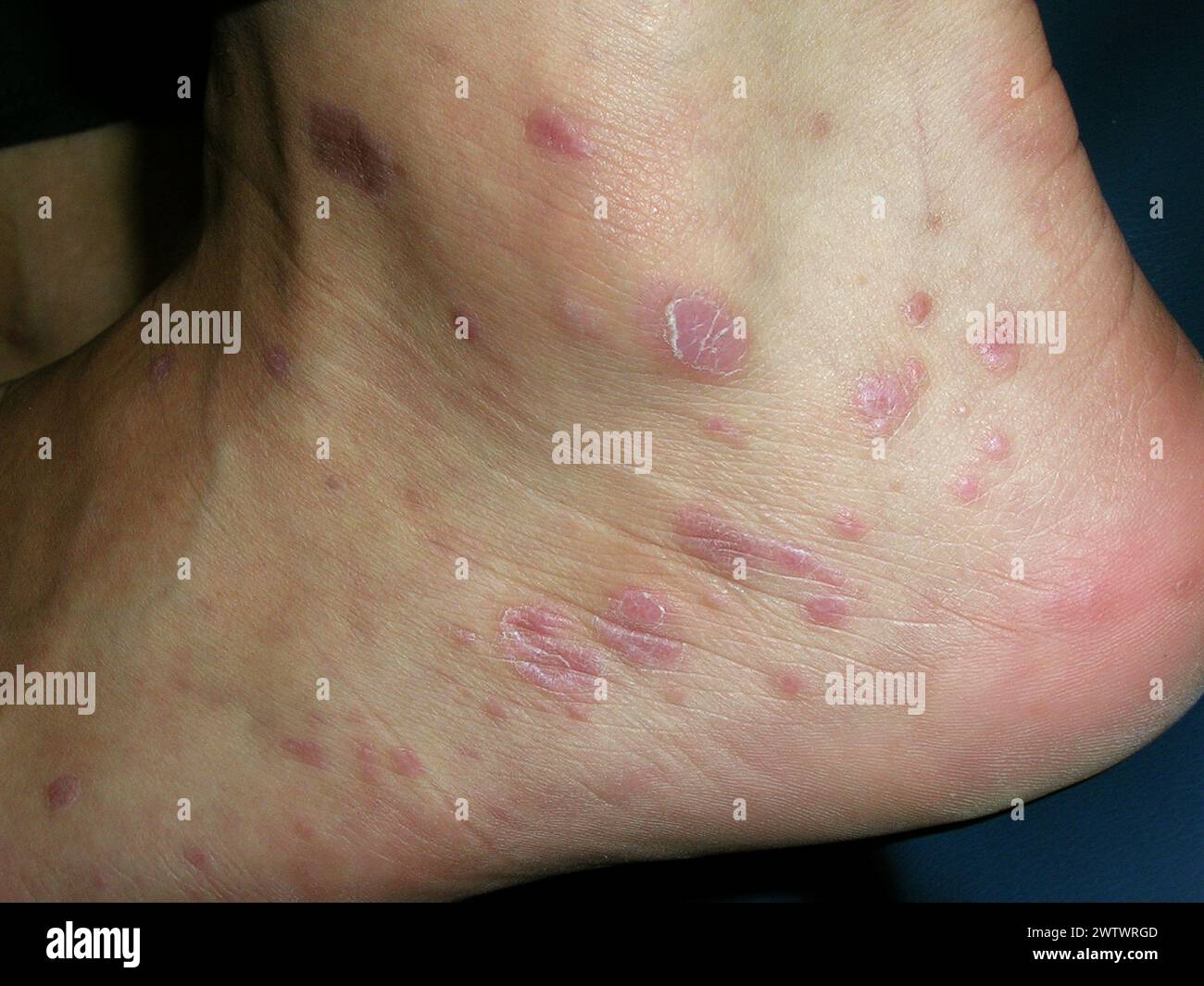 Not to be used for advertising or in a defamatory context Lichen planus ...