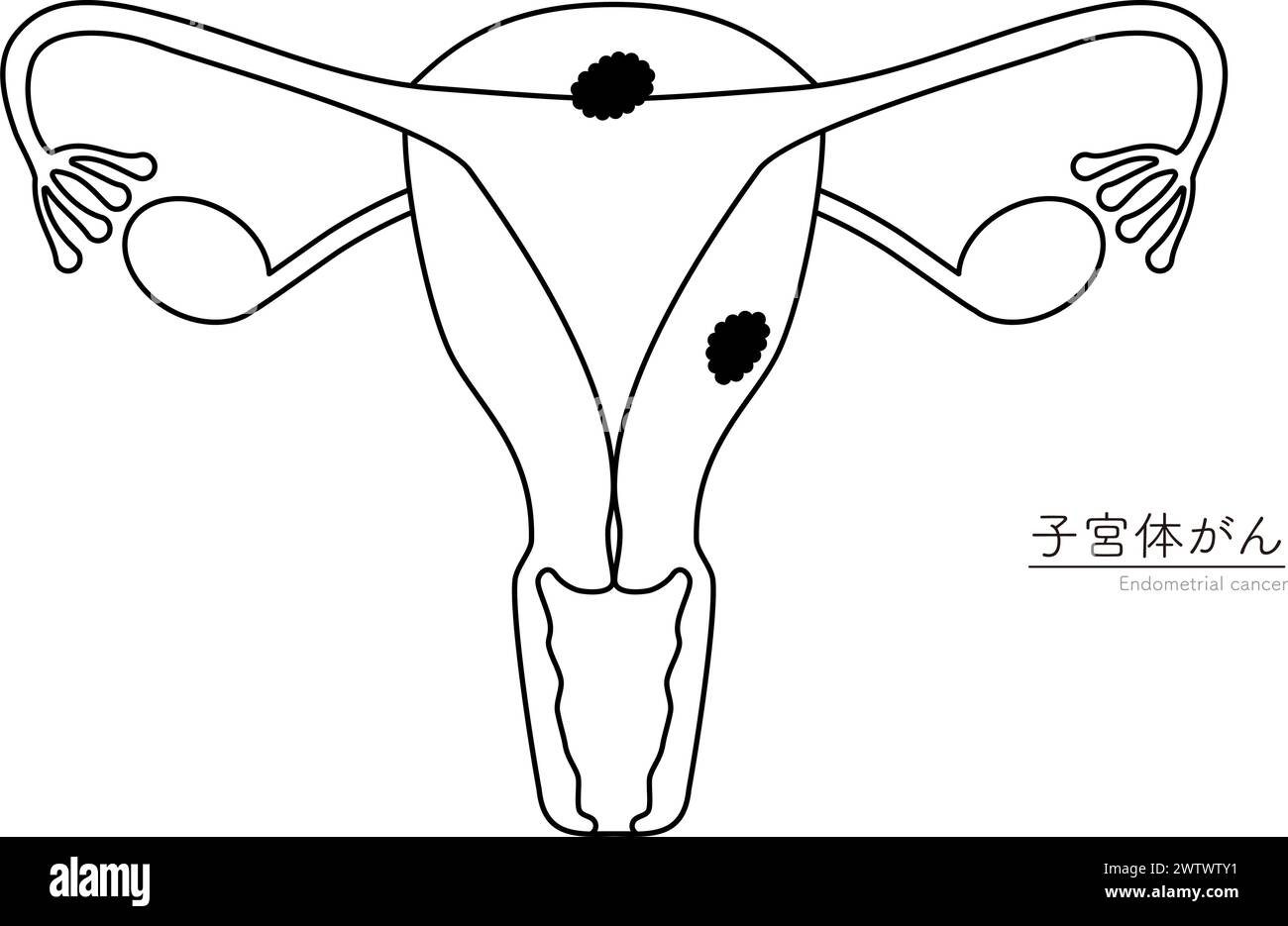 Illustrative illustrations of Endometrial cancer, anatomy of the uterus ...