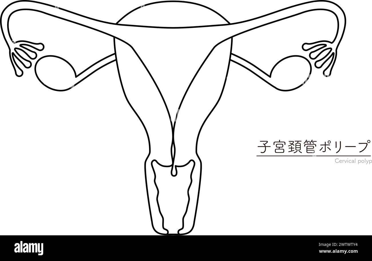 Diagrammatic illustration of cervical polyps, anatomy of the uterus and ...
