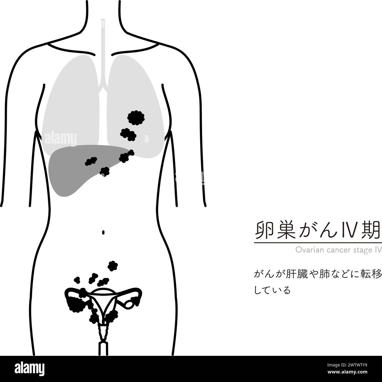 Diagrammatic Illustration Of Stage Iv Ovarian Cancer Anatomy Of The