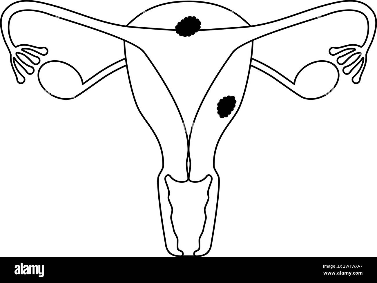Illustrative illustrations of Endometrial cancer, anatomy of the uterus ...