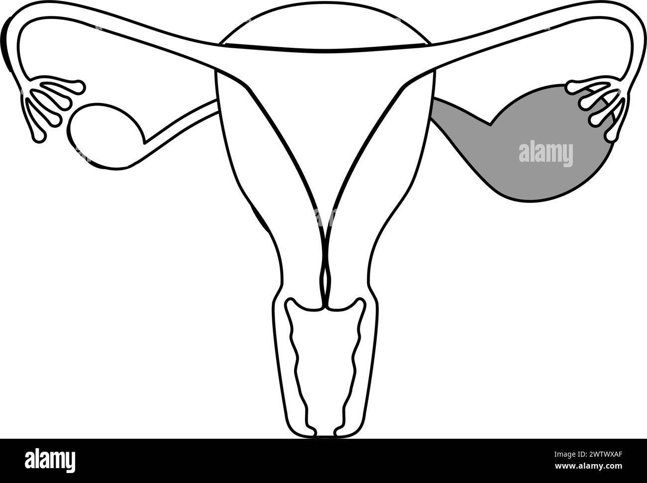 Diagrammatic Illustration Of Endometriosis Anatomy Of The Uterus And Ovaries Vector
