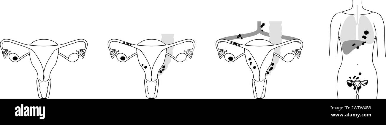 Diagrammatic Illustration Of Stage I Ovarian Cancer Anatomy Of The