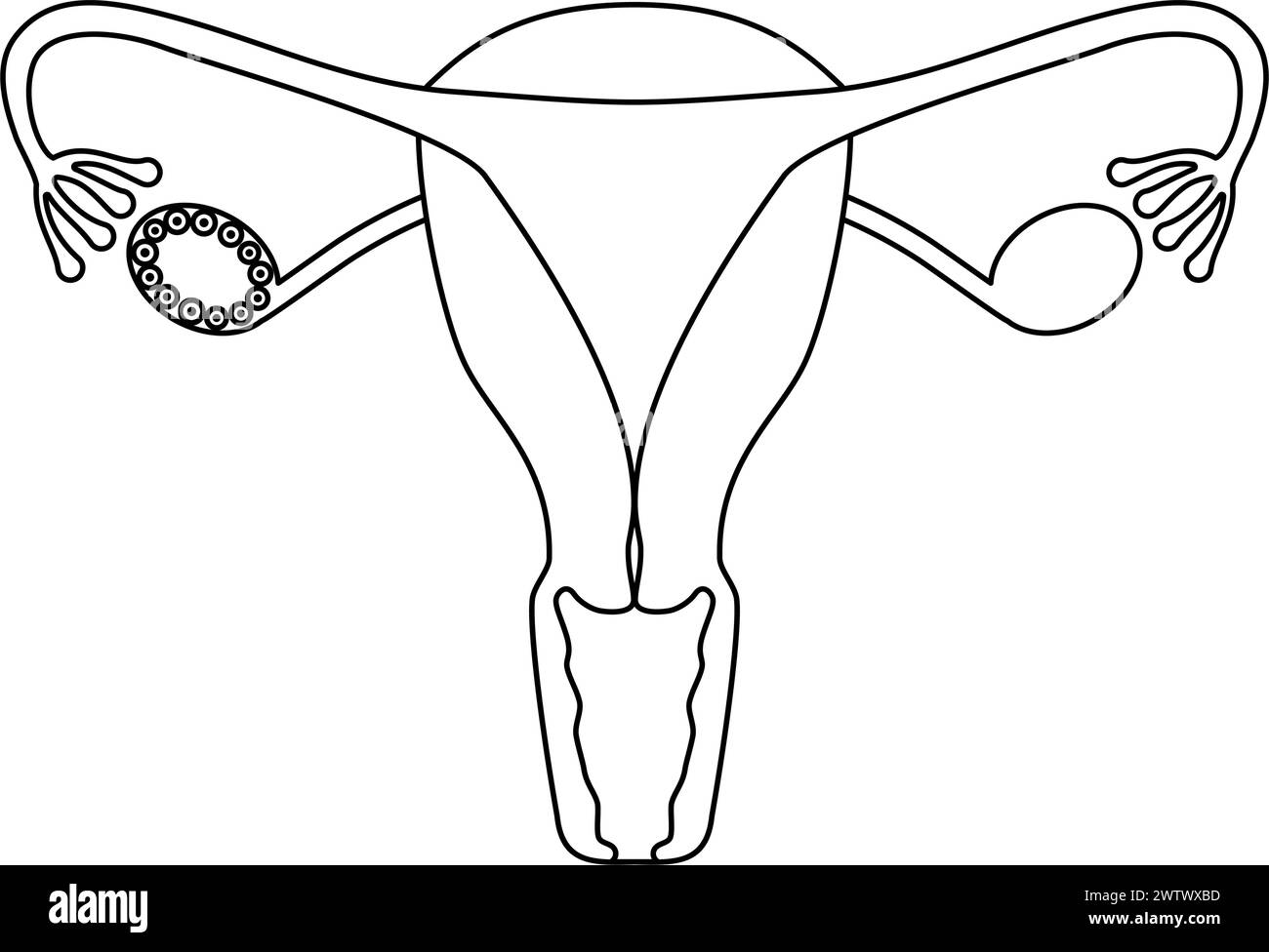 Diagrammatic Illustration Of Polycystic Ovary Syndrome Maturation Disorder Anatomy Of The