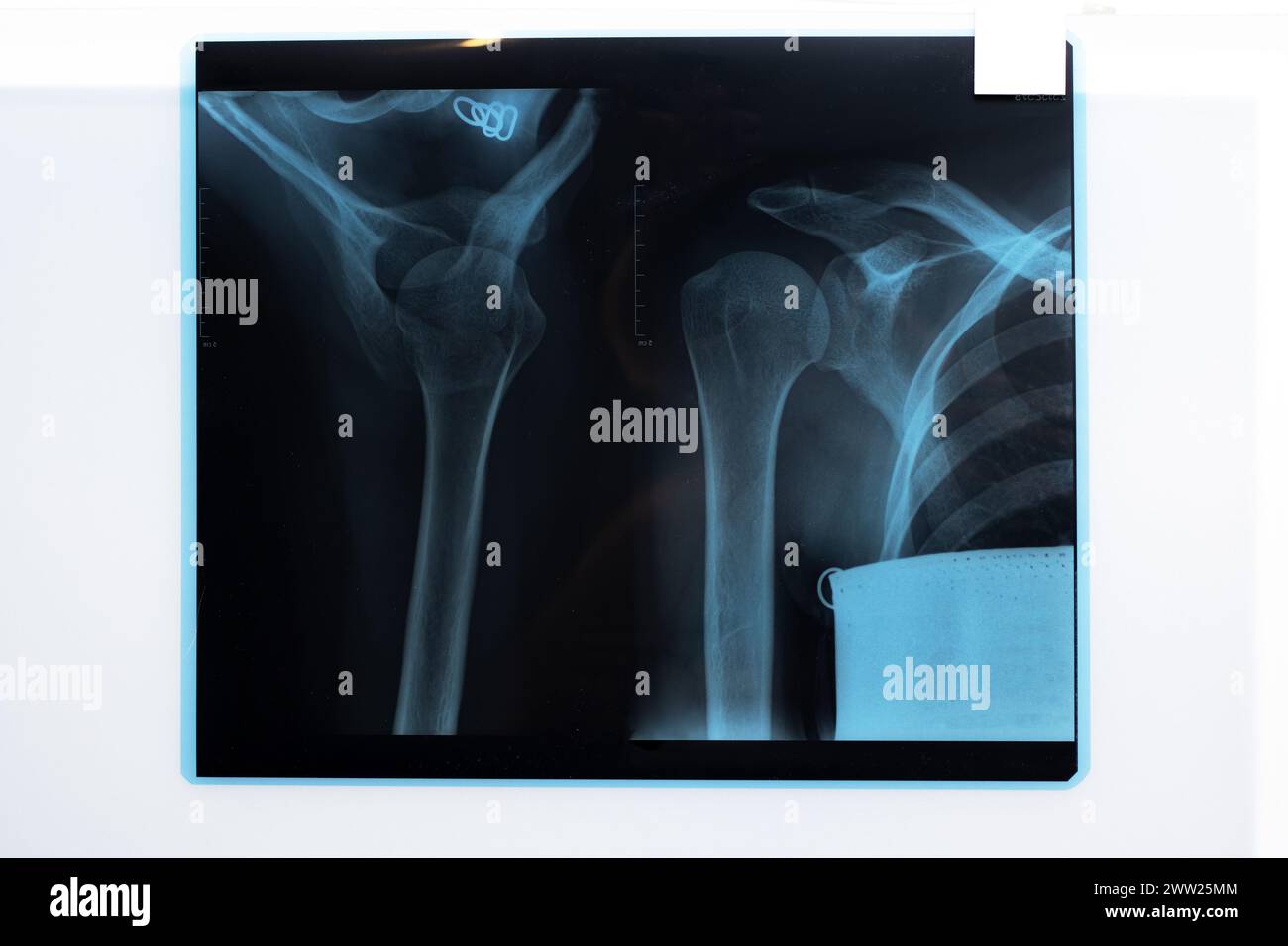 Normal shoulder joint x ray hi-res stock photography and images - Alamy