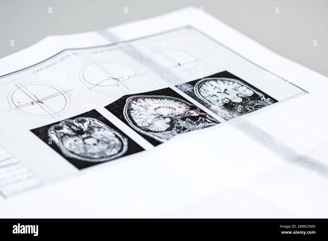 Baby brain scan hi-res stock photography and images - Alamy