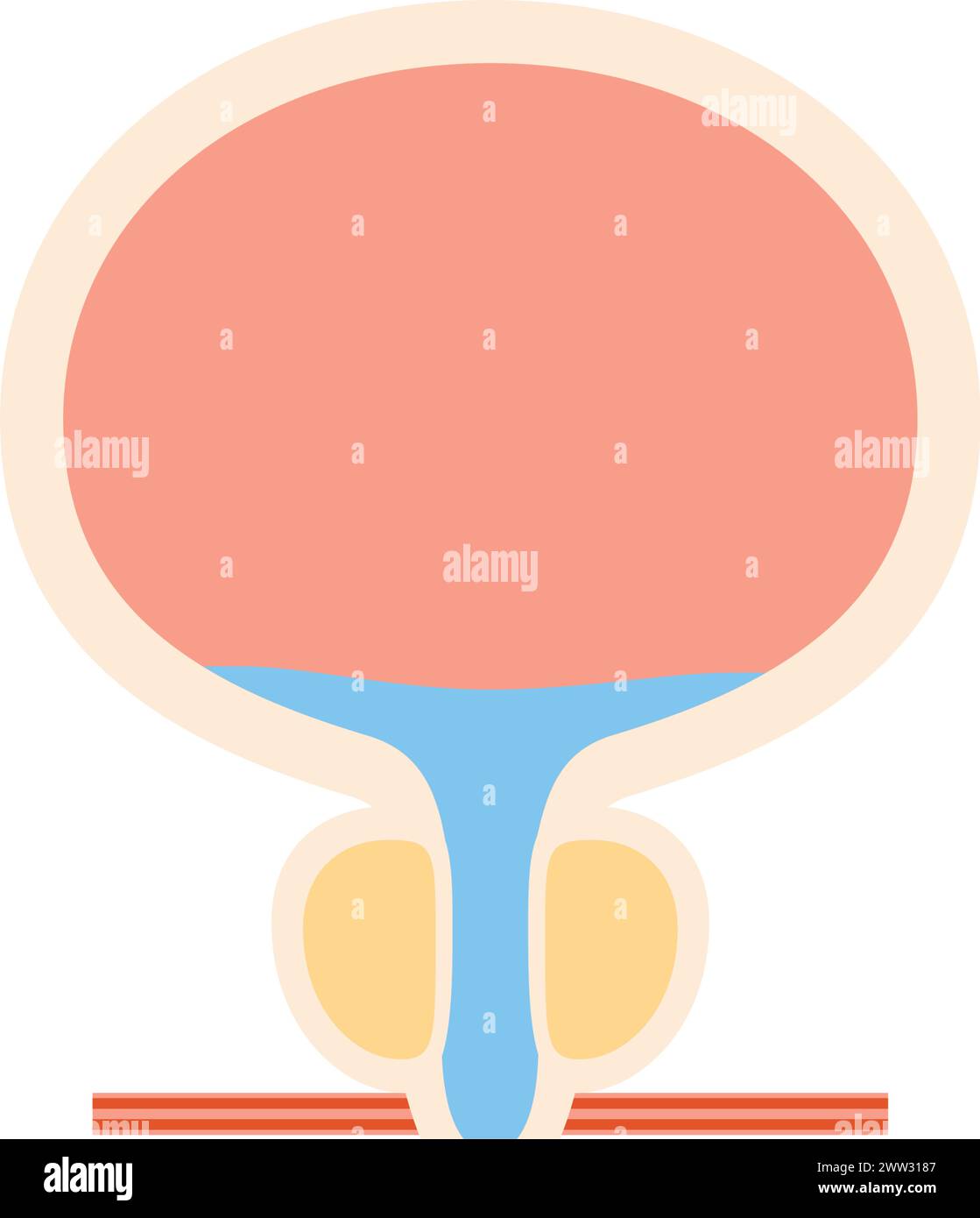 Medical illustration of benign prostatic hyperplasia, normal prostate ...