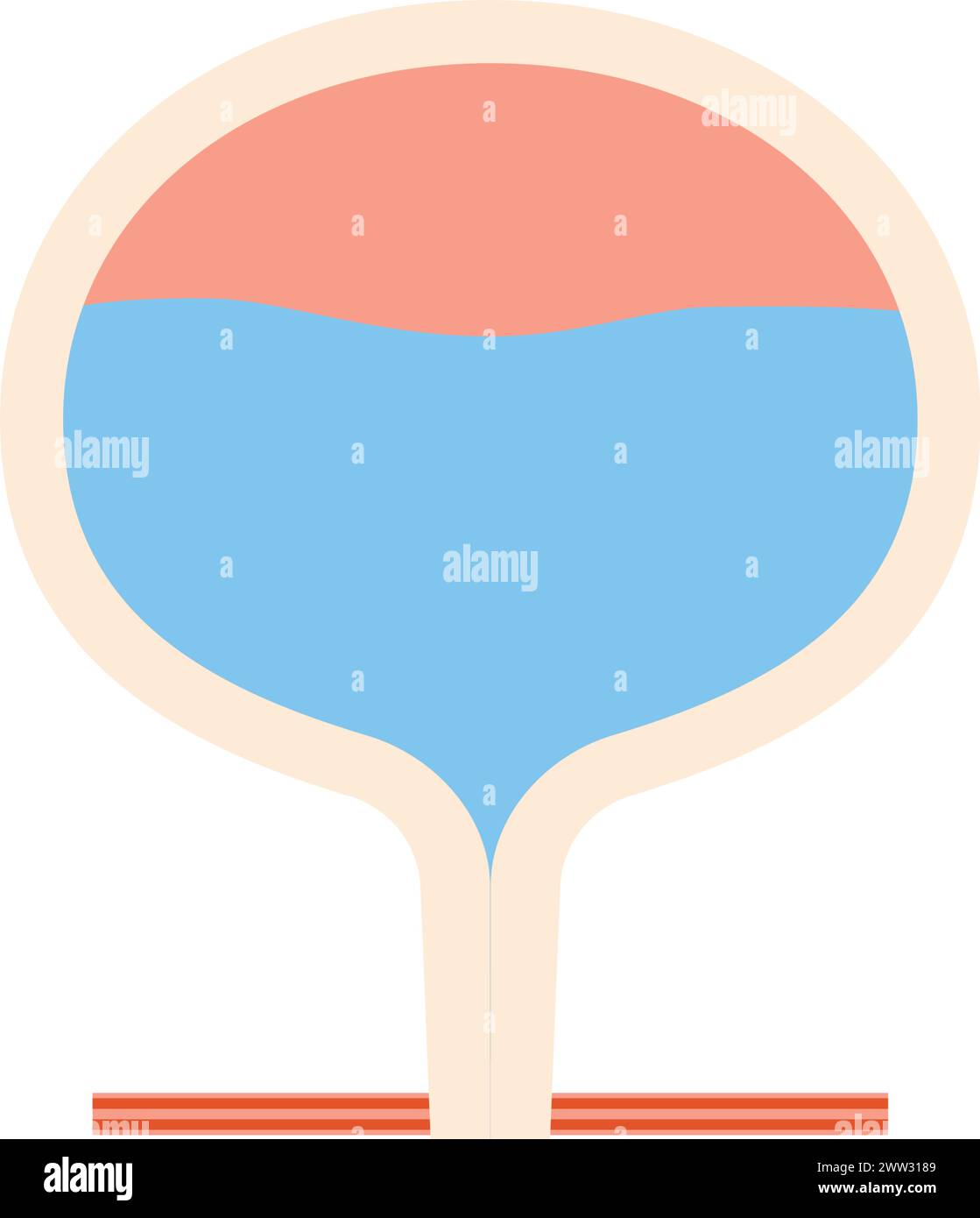 Medical illustration of overactive bladder, a condition in which the normal bladder holds back ...